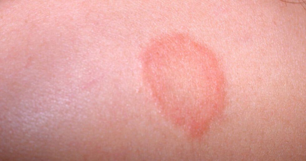 Dry skin patches: Causes, symptoms - Elegancy Beauty Bar